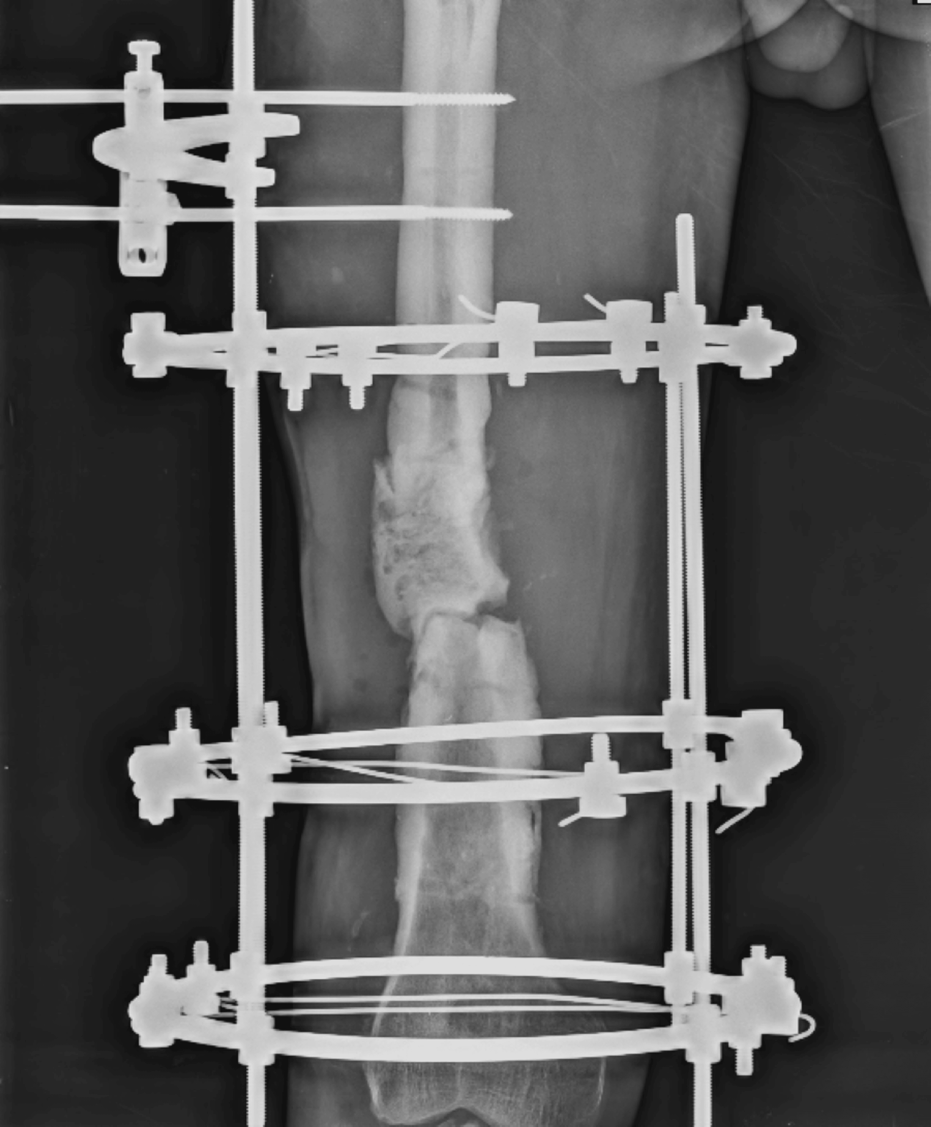Physical Rehabilitation Subsequent to Fixation of Ilizarov Ring Fixator ...
