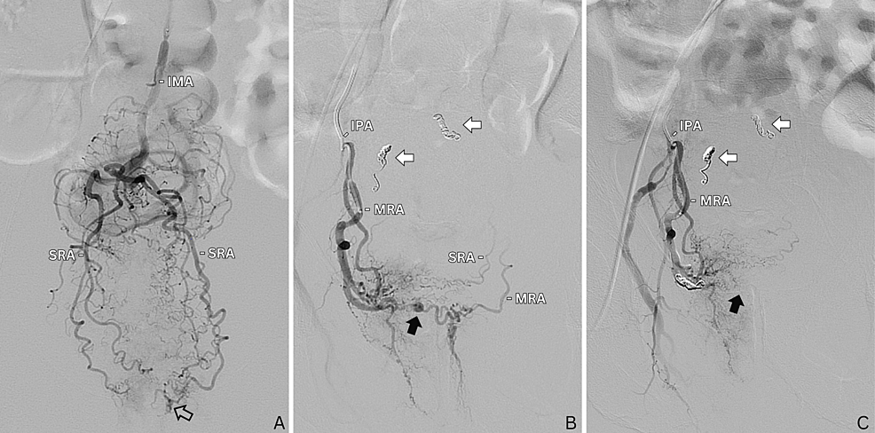 Cureus Middle Rectal Artery Pseudoaneurysm A Case Of Massive Lower