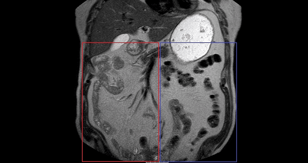An Unusual Coexistence: Right-Sided Colon Cancer and Intestinal ...