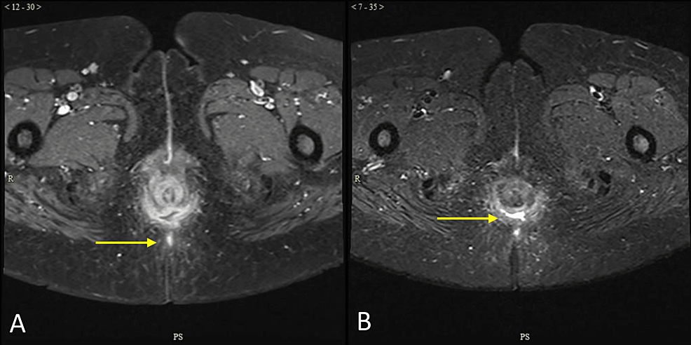 Ischiorectal Abscess Mri