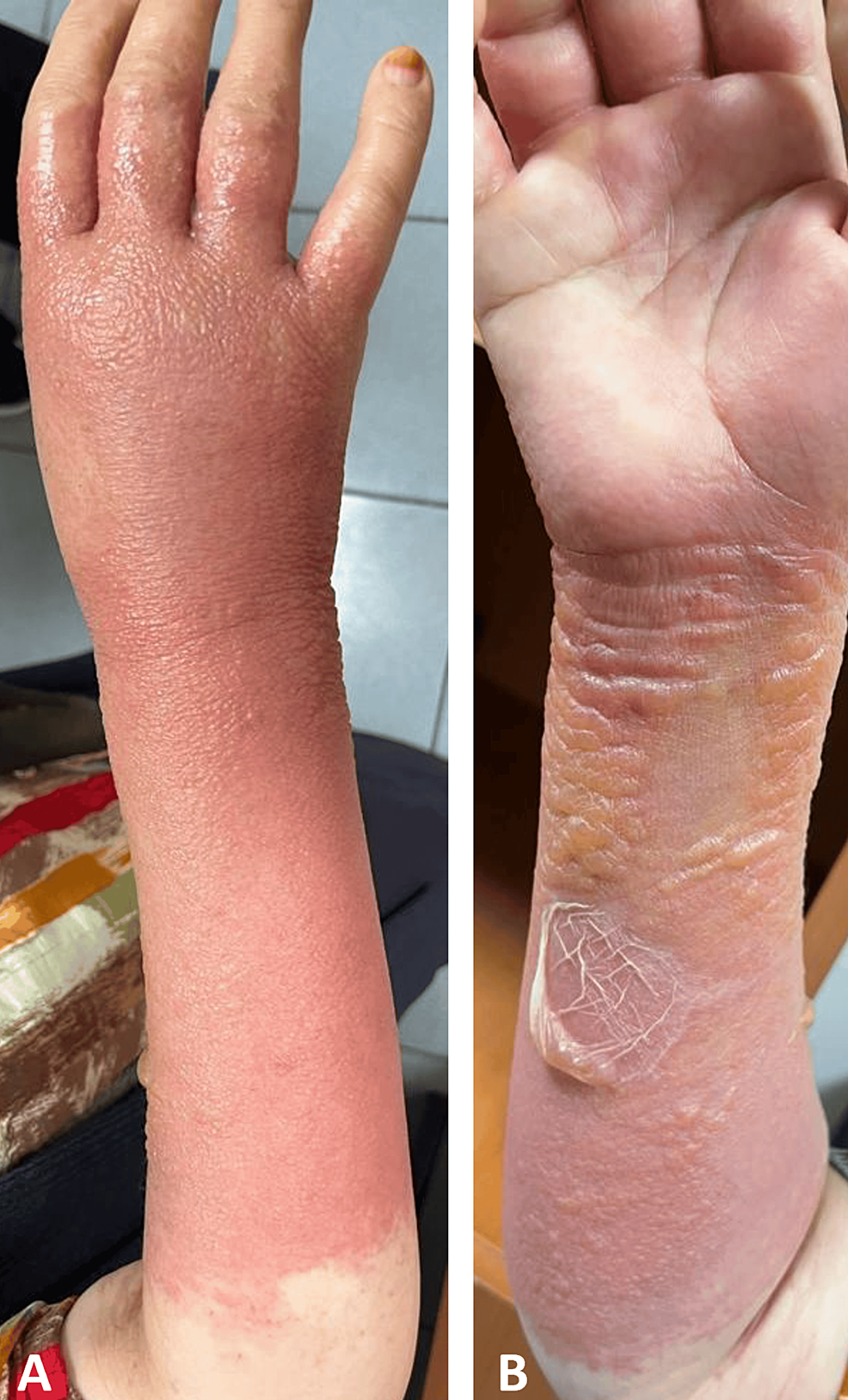 Allergic Contact Dermatitis in the Right Forearm Following Splint ...