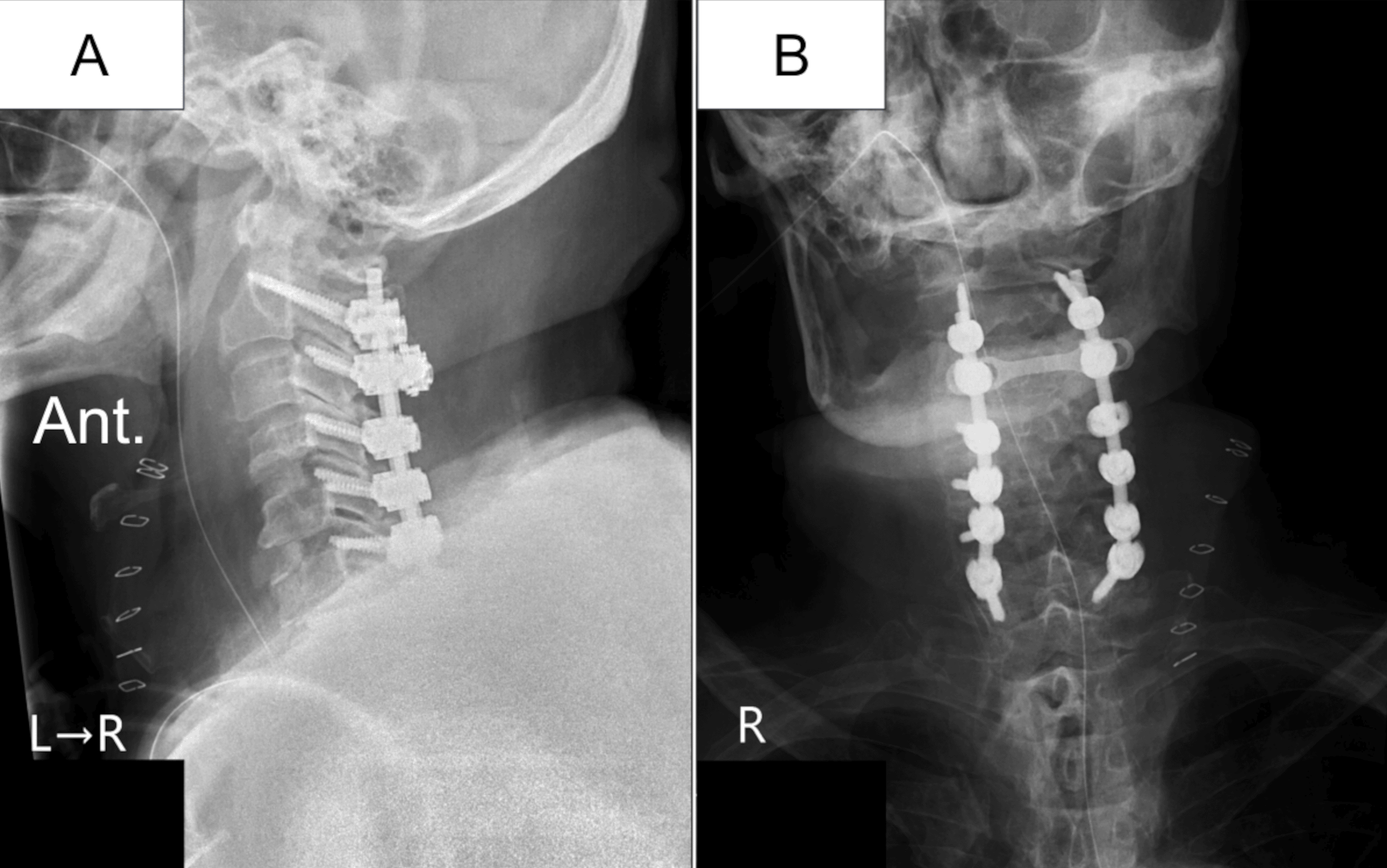 Two-Stage Cervical and Thoracic-Lumbar-Sacral Circumferential Fixation ...