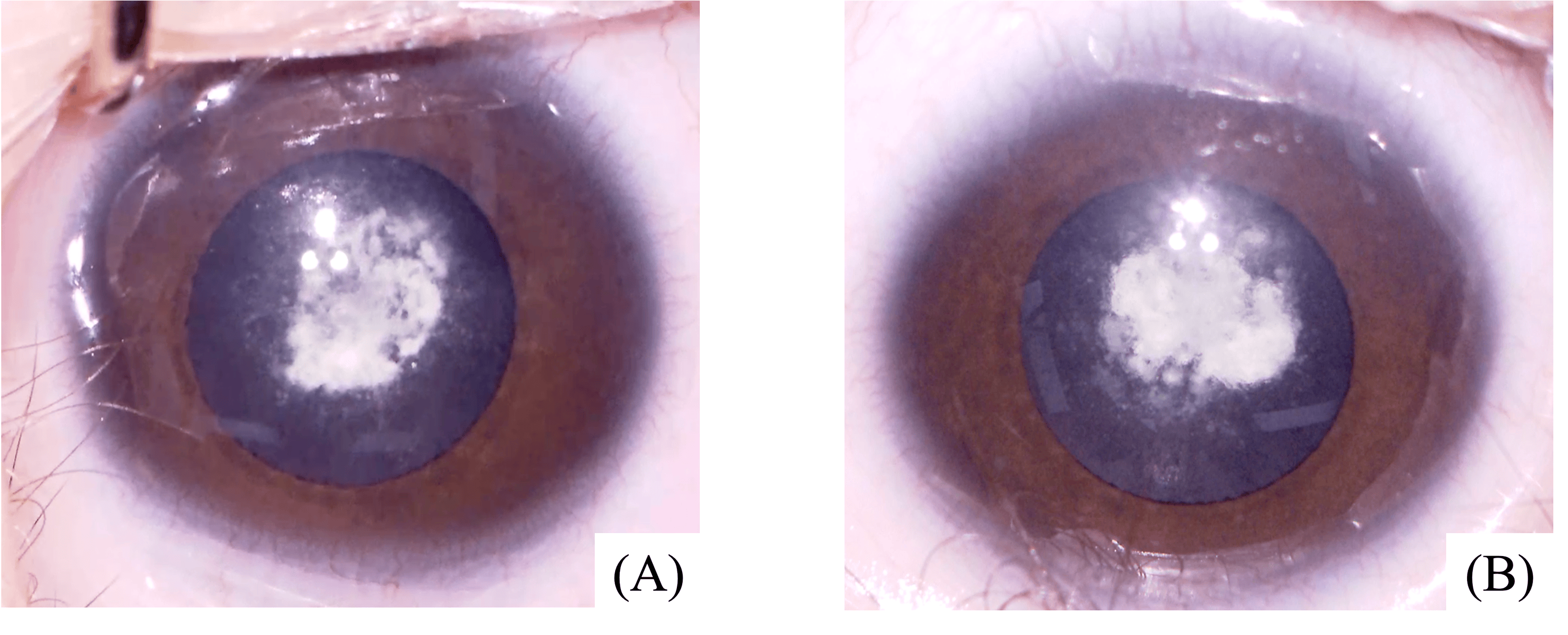 Early Detection and Treatment of Congenital Cataracts Using Fetal ...