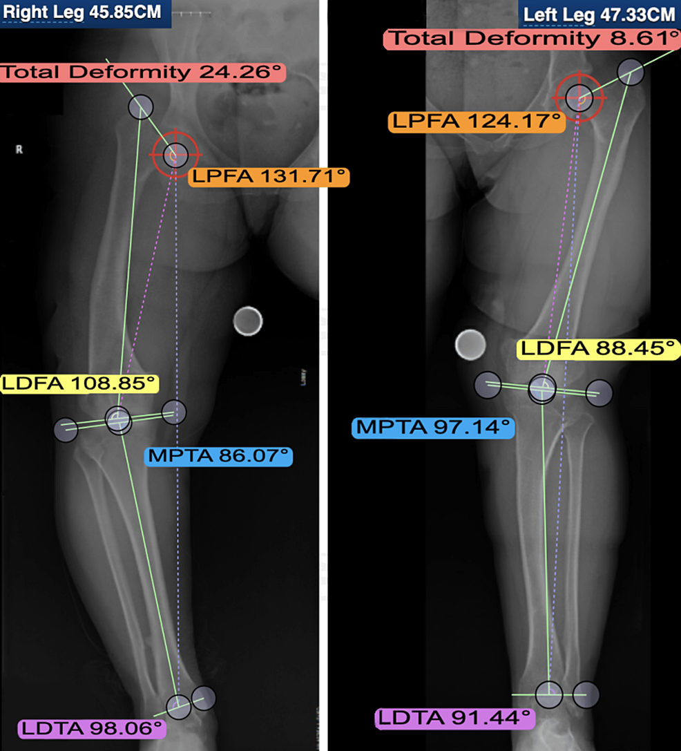 Cureus | Analyzing the Accuracy of Digital Sizing on Long-Leg Alignment ...