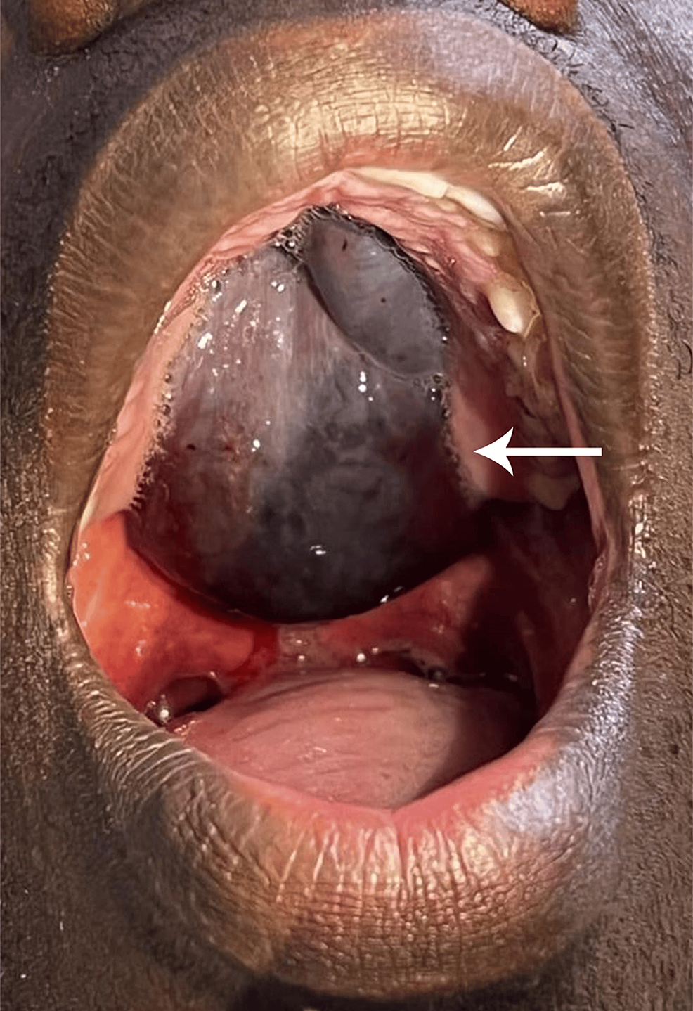 Angina Bullosa Hemorrhagica of the Oral Cavity A Case Report Cureus