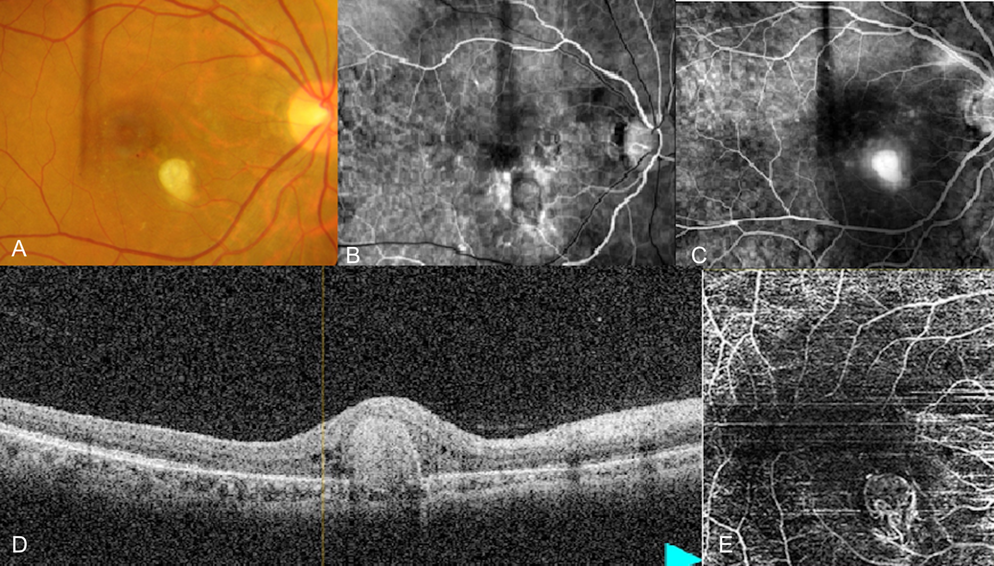 Cureus | Features and Diagnostic Accuracy of Optical Coherence ...