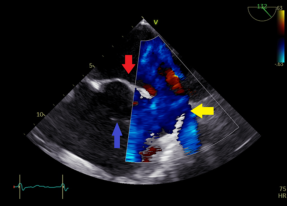 Cor Triatriatum Dexter With a Sinus Venosus Atrial Septal Defect in a ...
