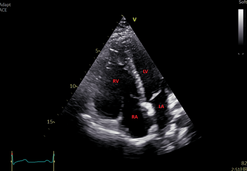 An Unexpected Case of Severe Arrhythmogenic Right Ventricular ...