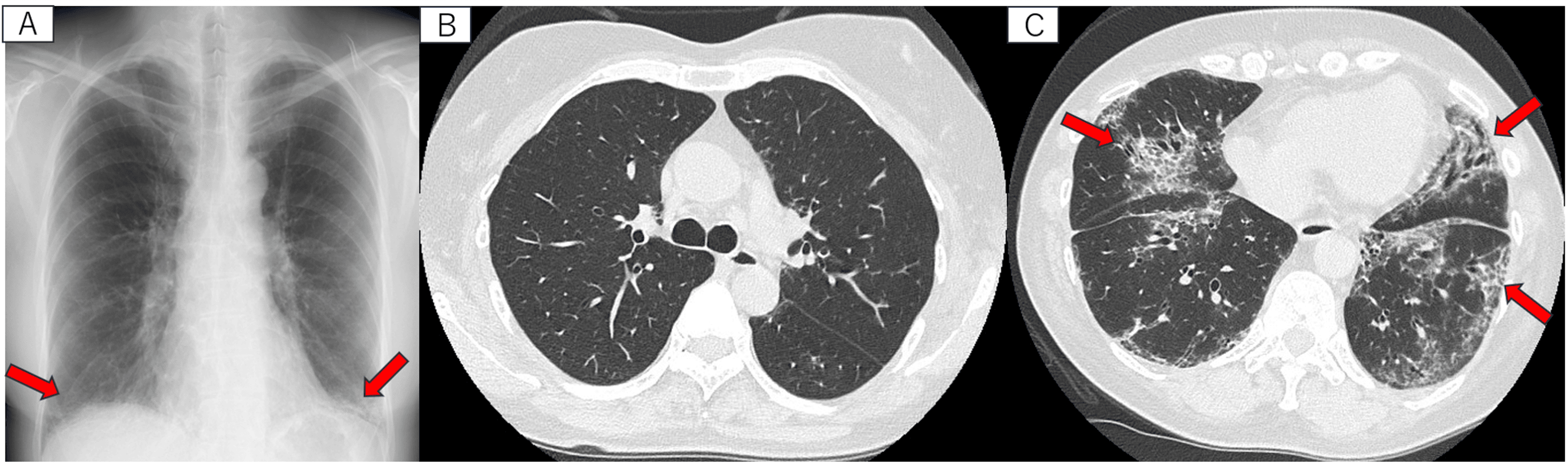 Negative-Pressure Pulmonary Edema Induced by Flexible Bronchoscopy: A ...