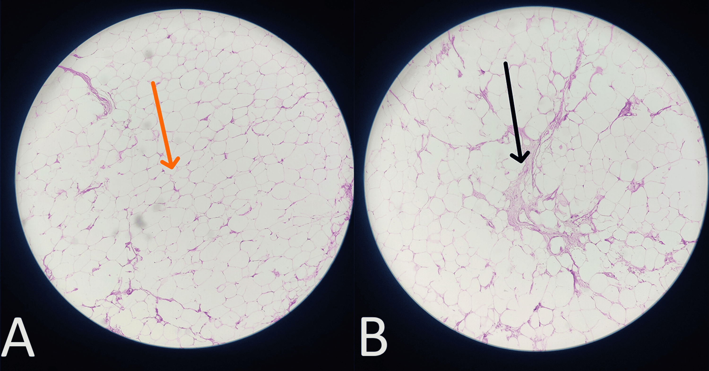 Surgical Excision Of Lipomas In Bilateral Upper Limbs And Right Thigh
