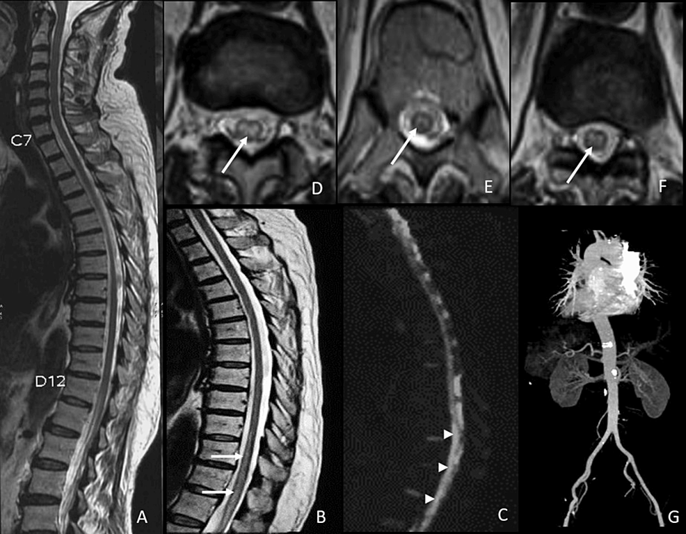 spinal cord stroke