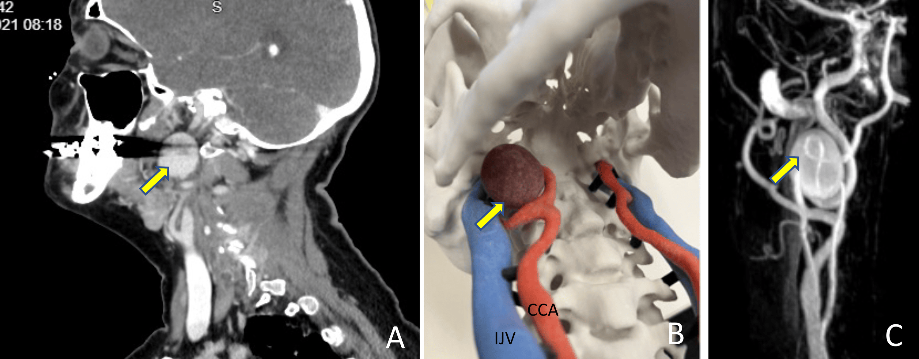 Multidisciplinary Management of an Internal Carotid Artery Aneurysm ...