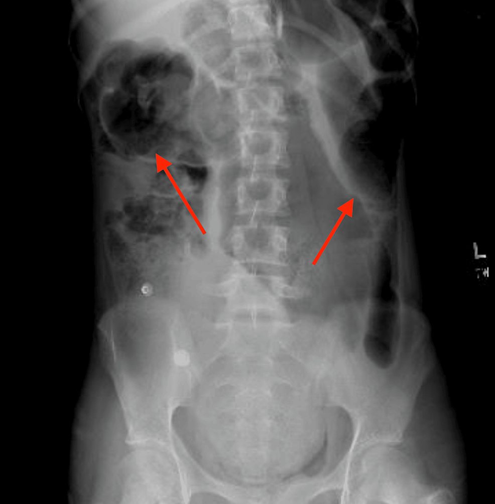 Stercoral Colitis: An Unexpected Presentation in a Young Adolescent ...
