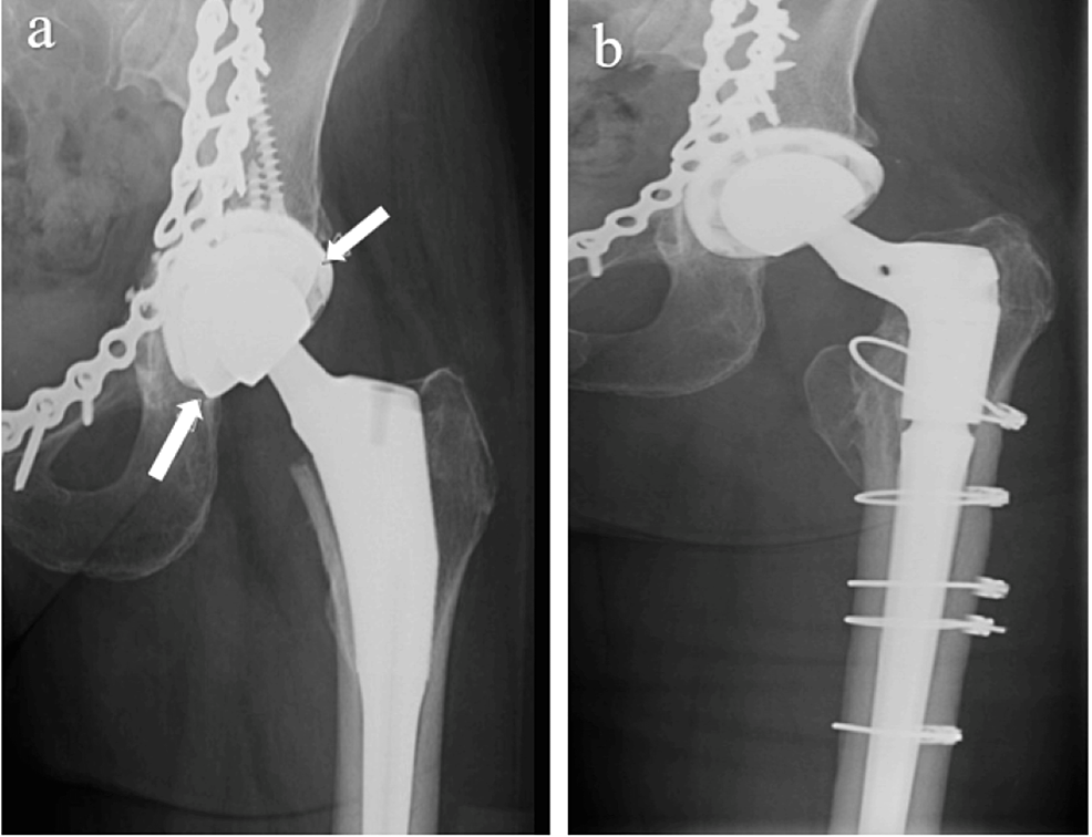 Malseated Liner in Modular Dual Mobility Total Hip Replacement: A ...