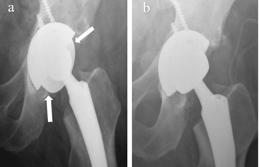 Malseated Liner in Modular Dual Mobility Total Hip Replacement: A ...