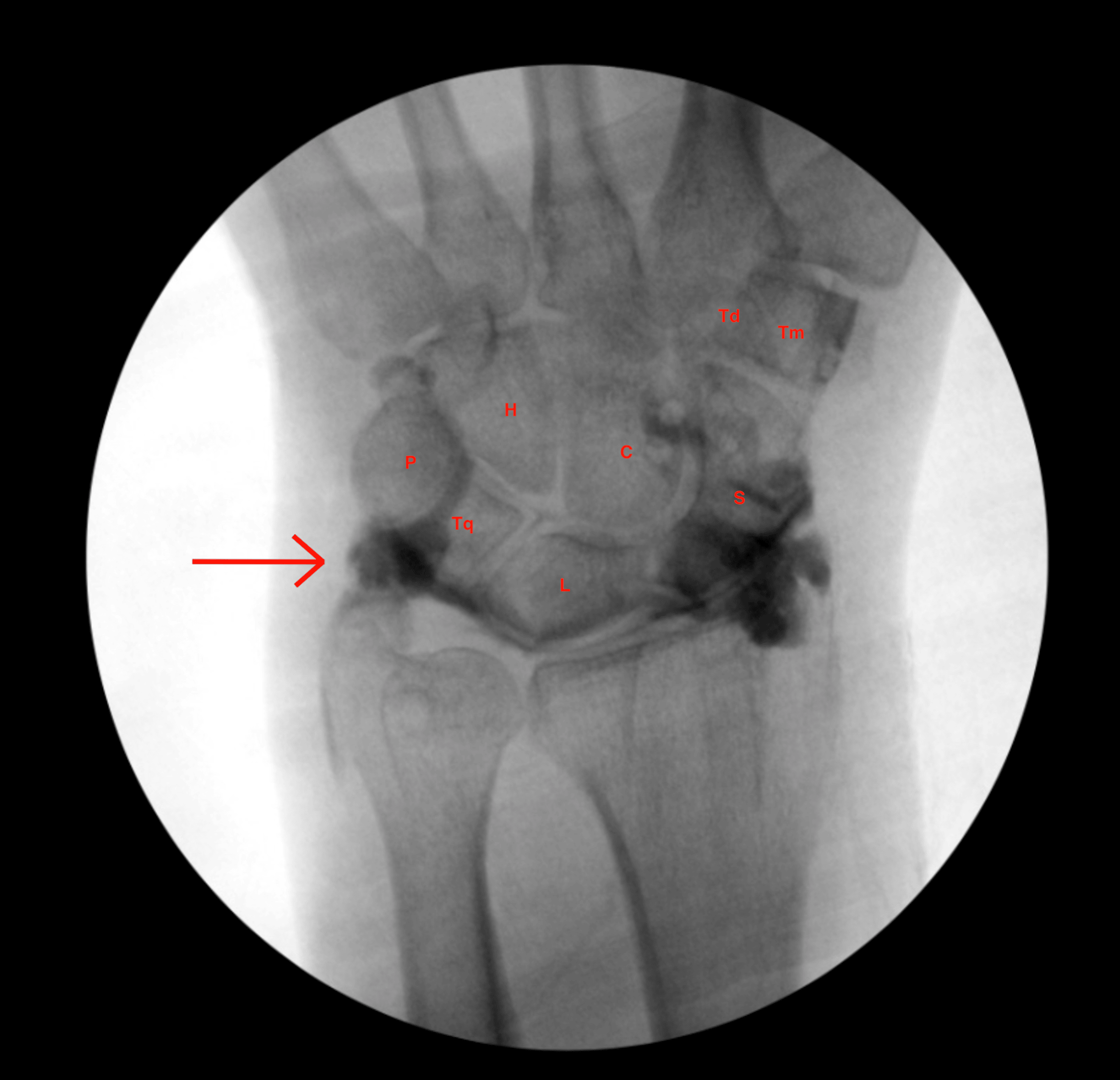 Ulnocarpal Abutment Syndrome With Triquetrum Degeneration | Cureus