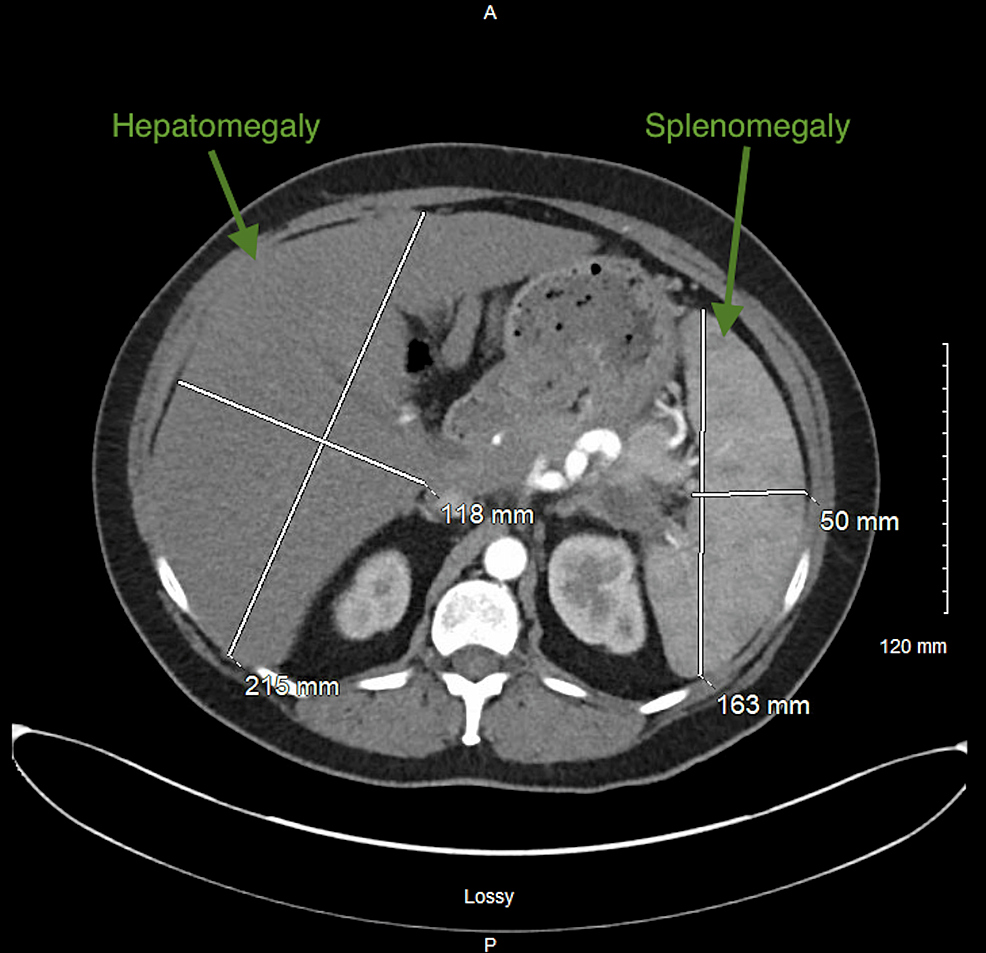Pseudo-Hypobicarbonatemia in Patients With Hypertriglyceridemia | Cureus