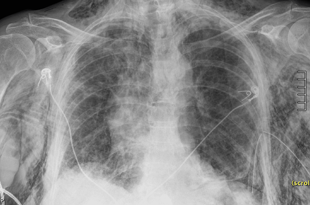 Secondary Spontaneous Pneumothorax in a Patient With Interstitial Lung ...