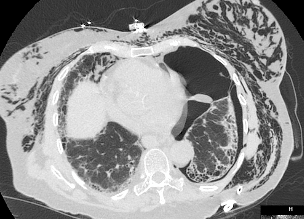 Secondary Spontaneous Pneumothorax in a Patient With Interstitial Lung ...