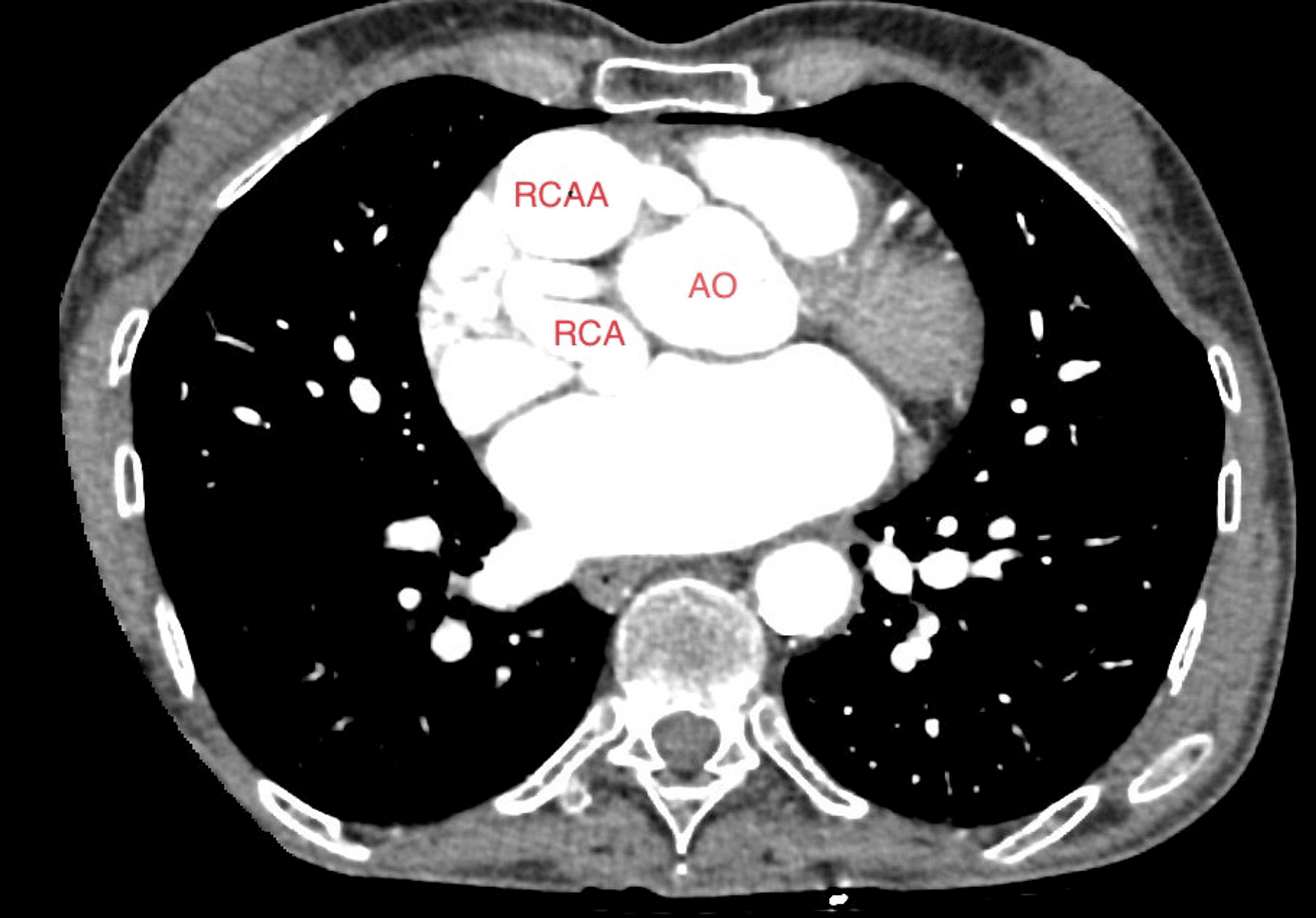 Right Coronary Artery-to-Right Atrial Fistula Accompanied by Multiple ...