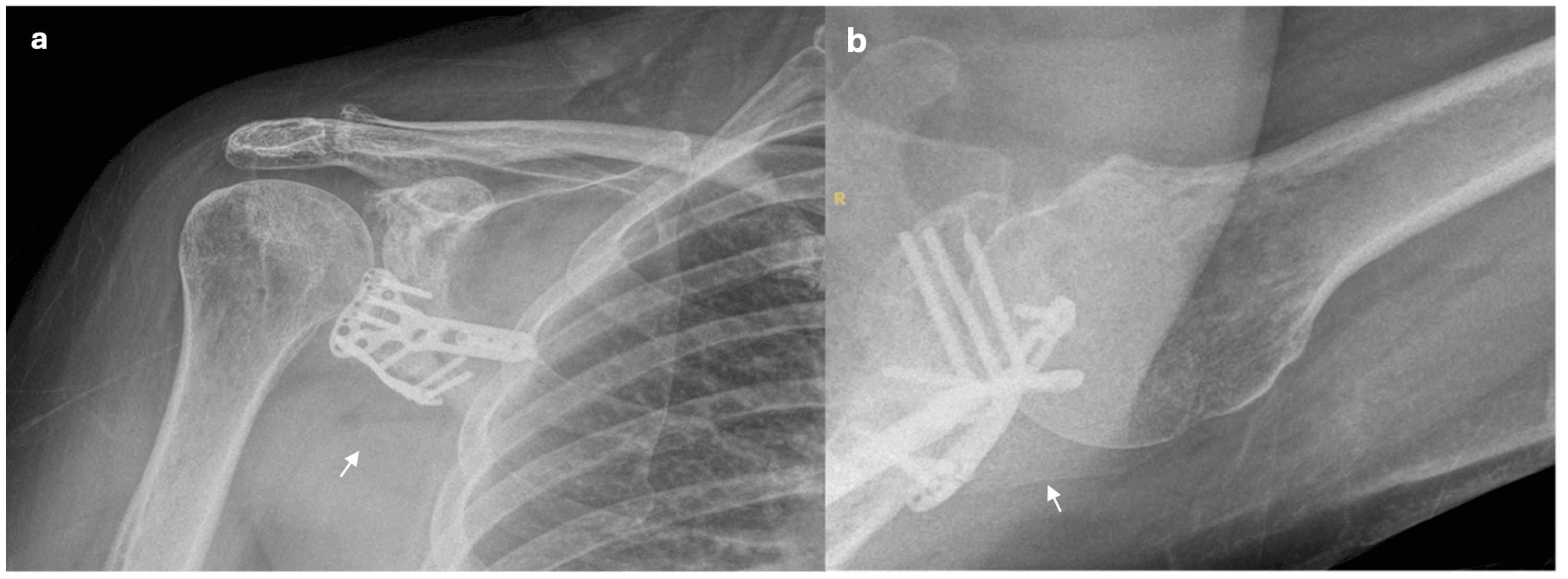 Glenoid Fracture Fixation Using An Acu Loc Distal Radius Plate Cureus