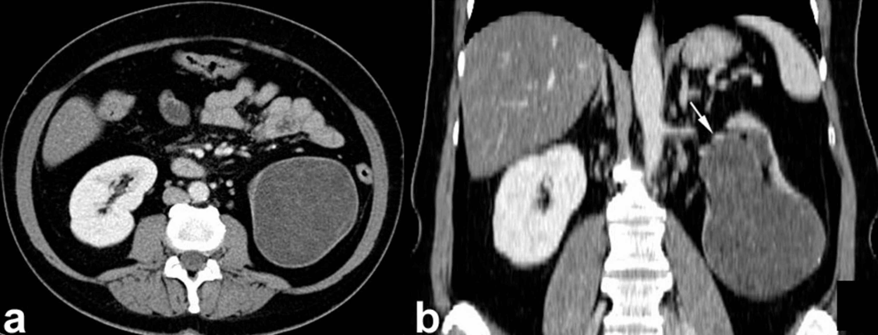 Renal Sinus Pathologies Depicted by CT Imaging: A Pictorial Review | Cureus