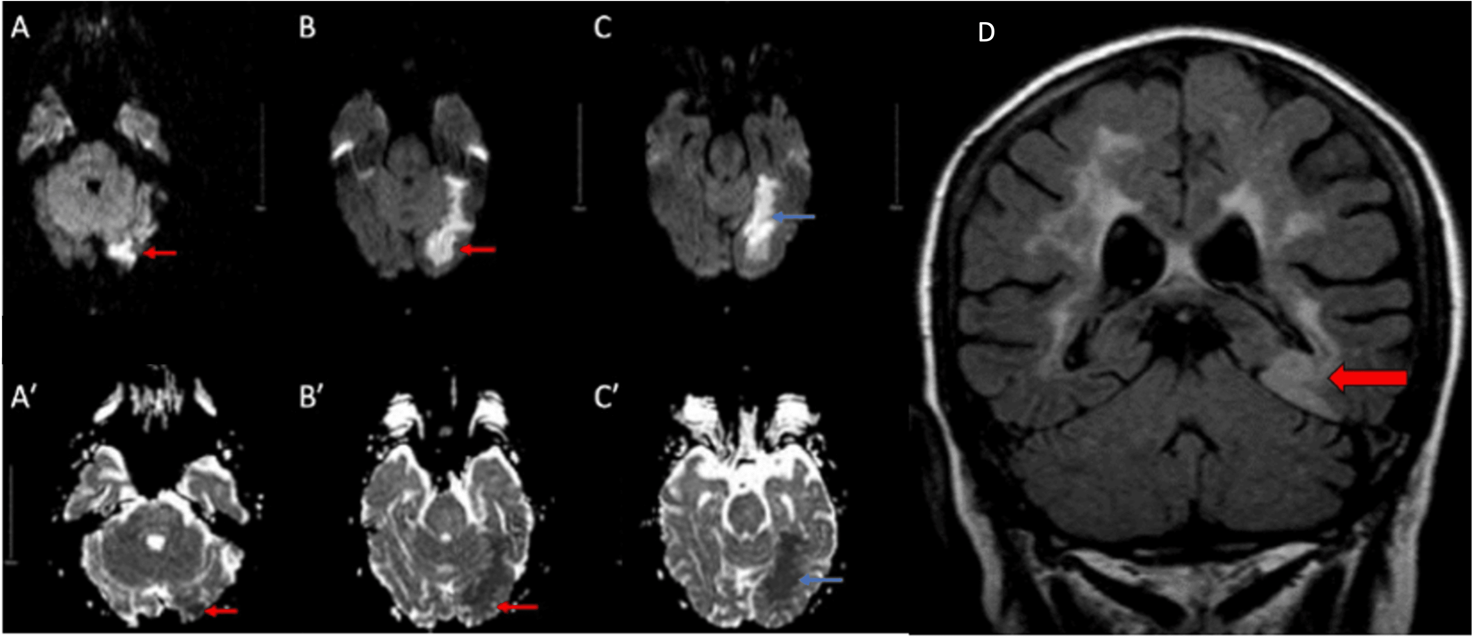 Clinicoradiological Features of Alexia Without Agraphia | Cureus
