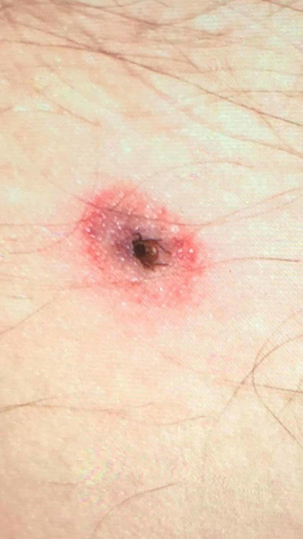 Cureus | Two Recent Cases of Babesiosis in the United States With a ...