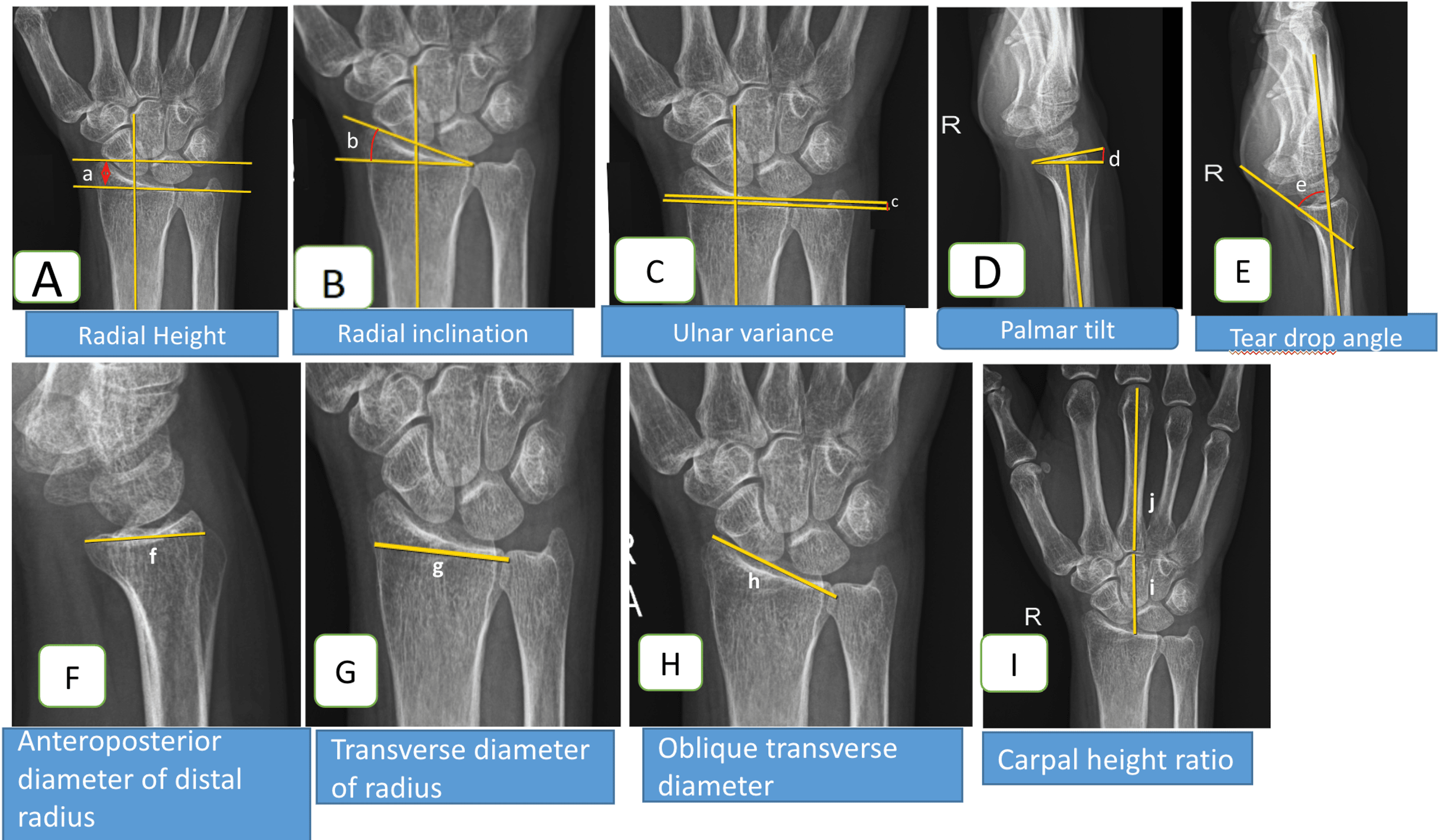 Radiographic Morphometric Analysis of the Distal Radius in the Tamil ...