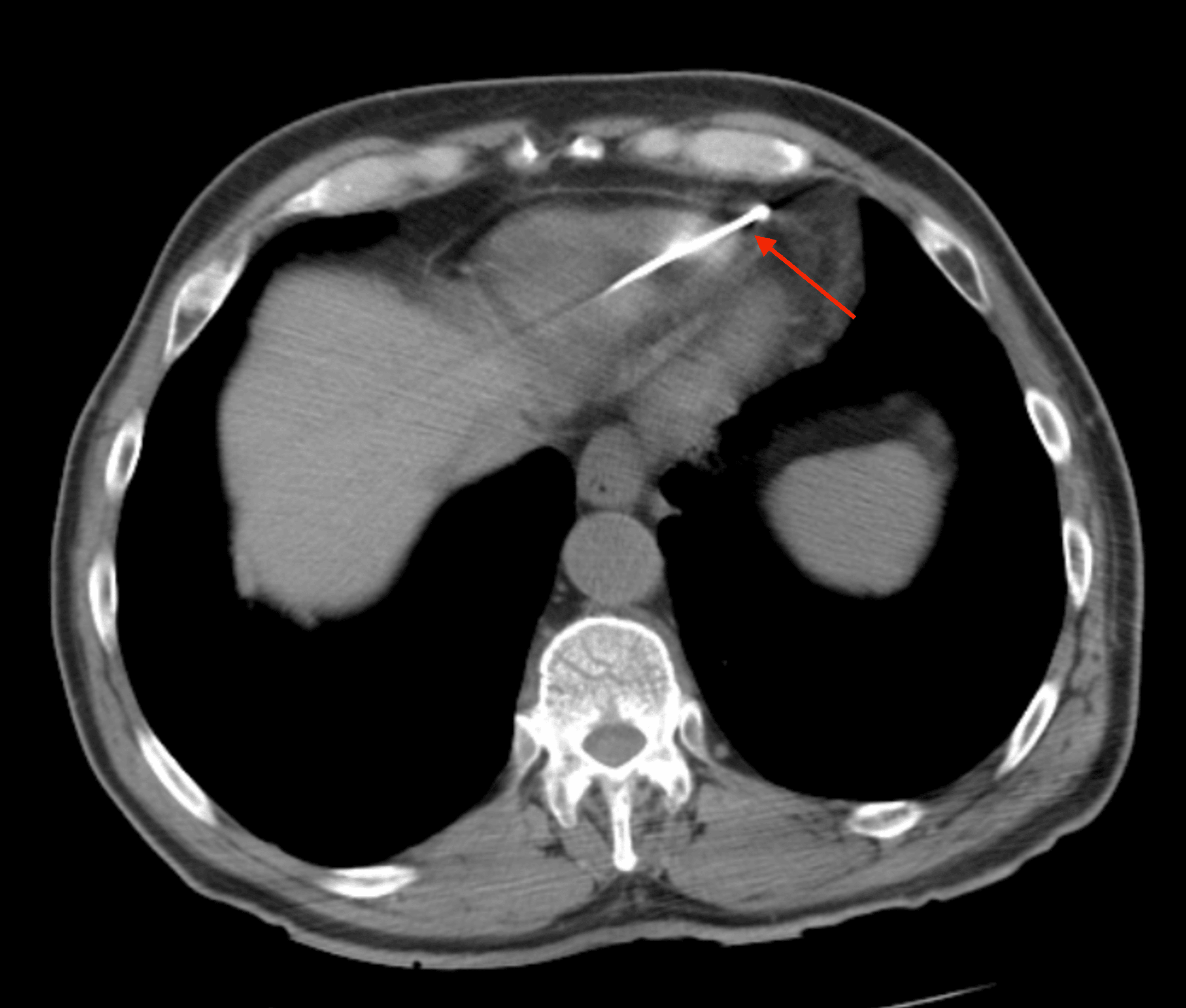 Unveiling a Critical Subacute Complication: Right Apical Septum ...