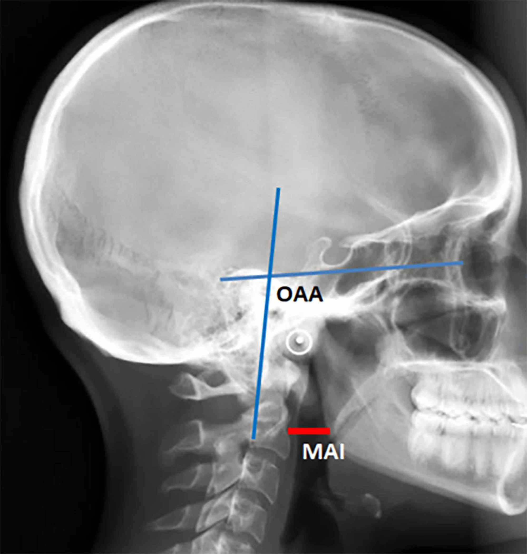 Cureus | Optimizing Alignment Parameters During Craniocervical ...