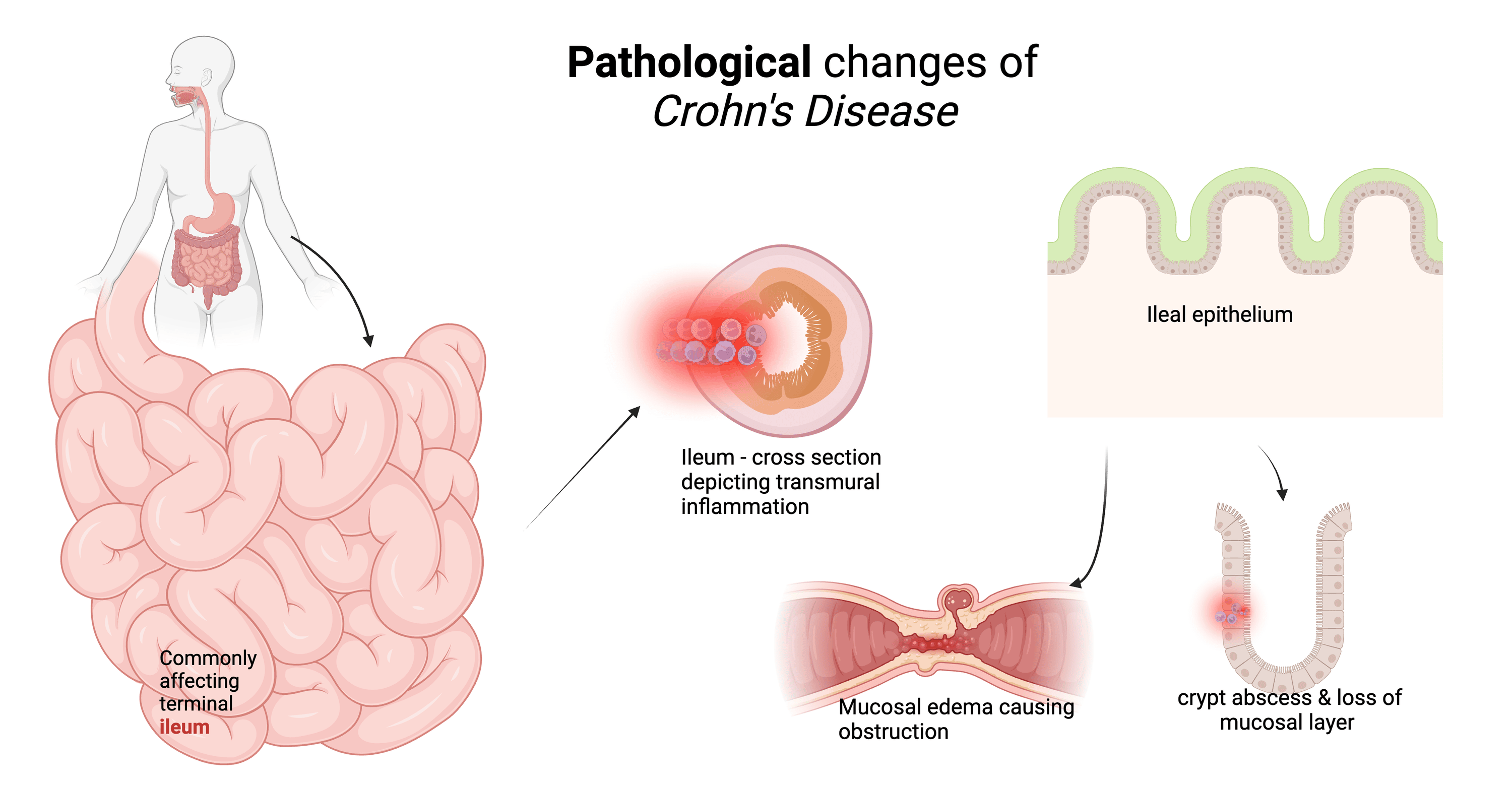 Advancements in Targeted Therapies for the Management of Crohn’s ...