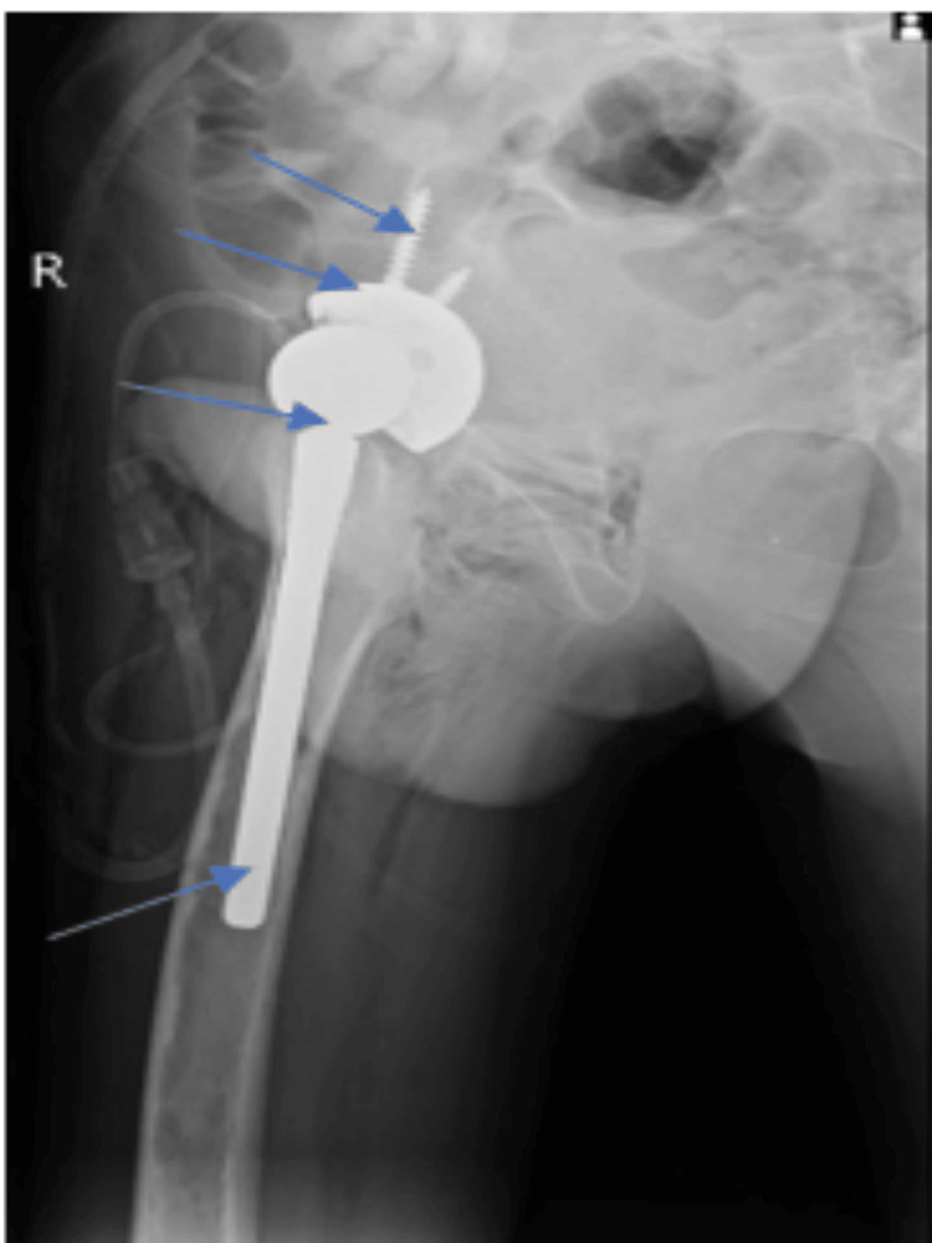 Proprioceptive Neuromuscular Facilitation (PNF)-Integrated Gait ...