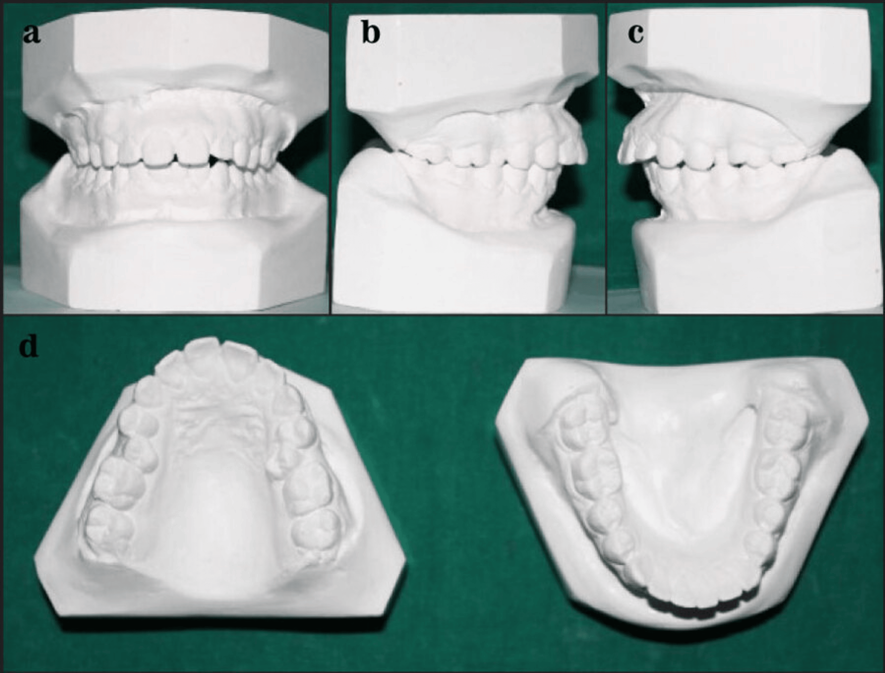 A Comparative Analysis of Arch Widths in Class I and Class II ...