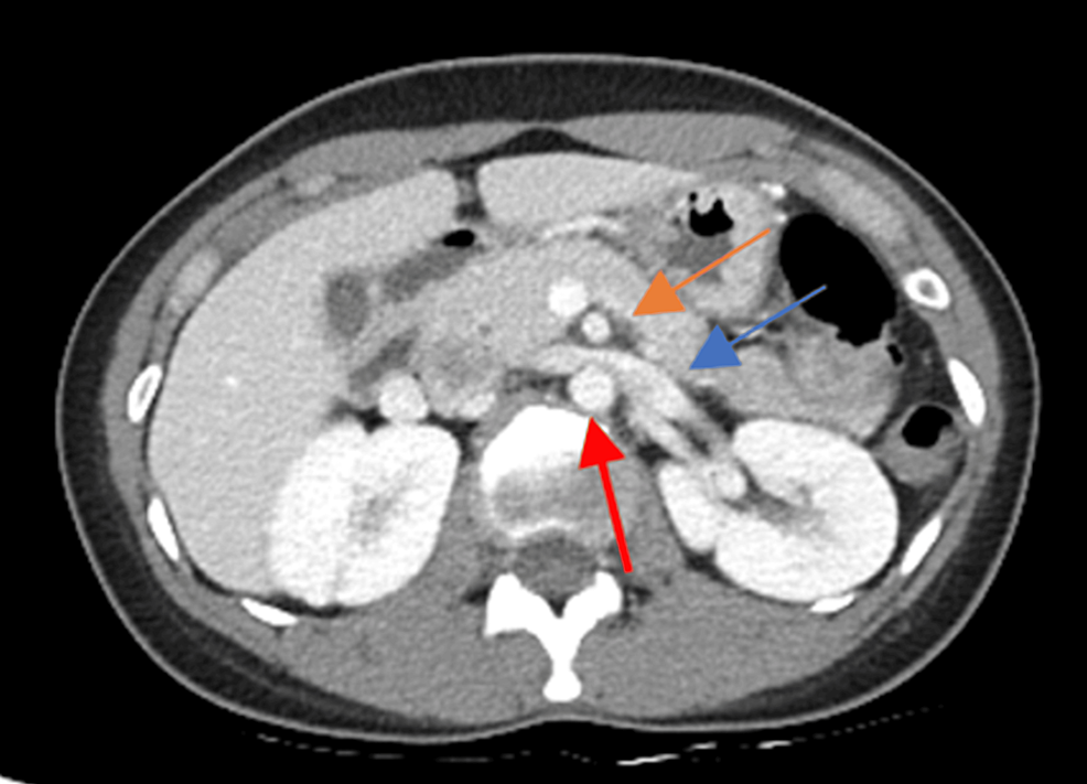 Cureus The Da Vinci Single Port Sp Treatment Of Nutcracker Syndrome