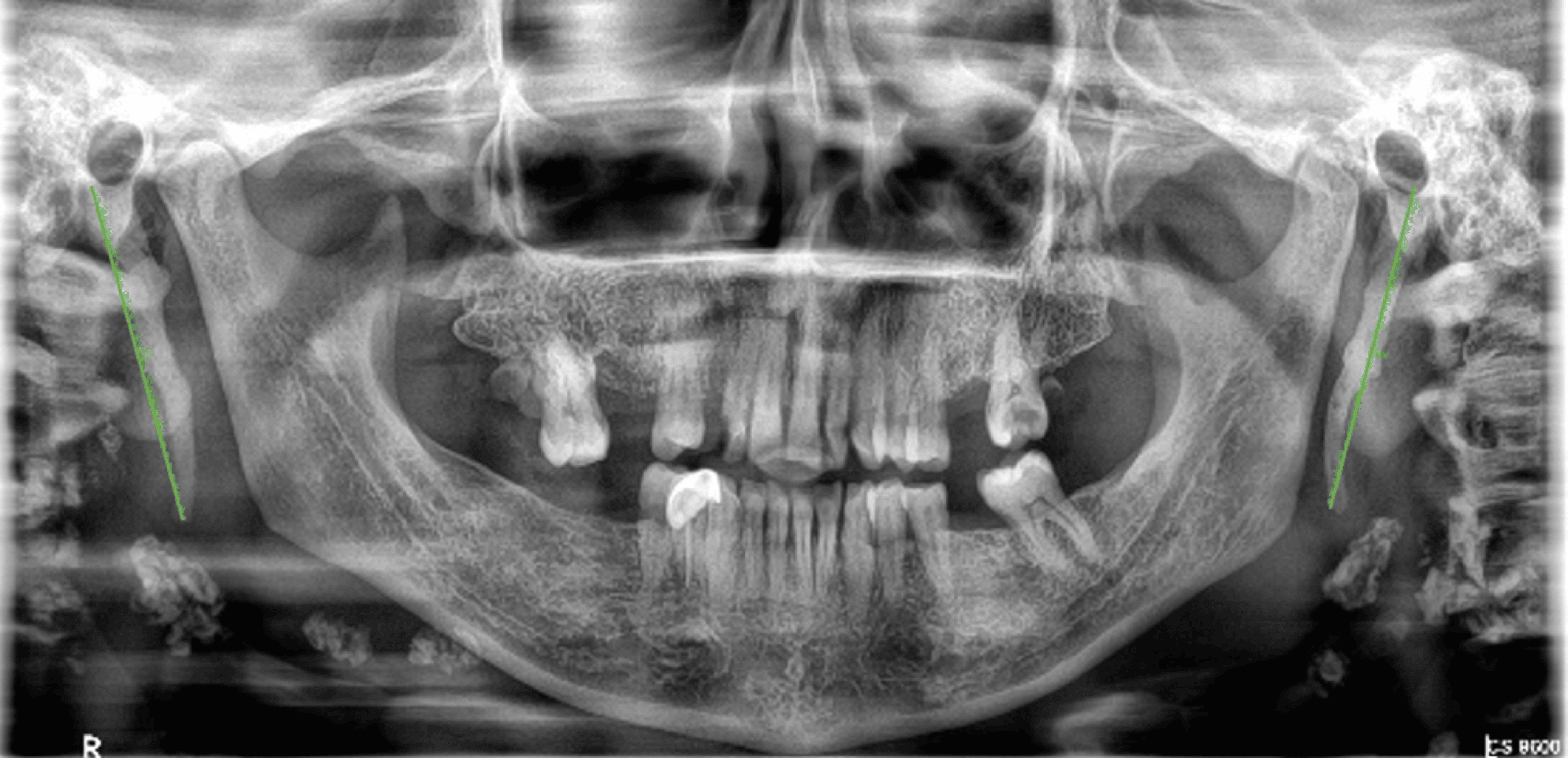 Cureus | Elongated Styloid Process Evaluation Using Panoramic ...