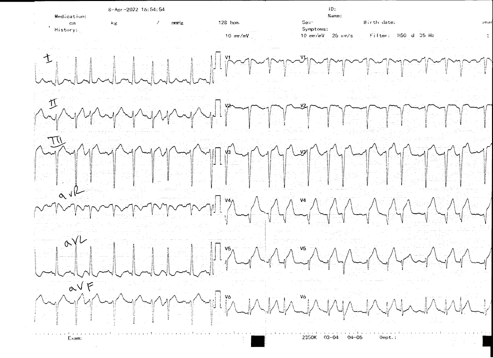 Marfan Syndrome Associated With Acute Myocardial Infarction in the ...