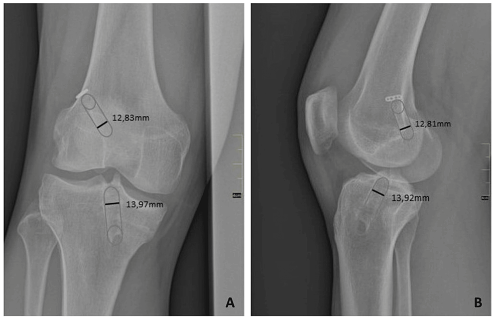 Cureus | Comparison of Cross-Pin Versus Cortical Button Femoral ...