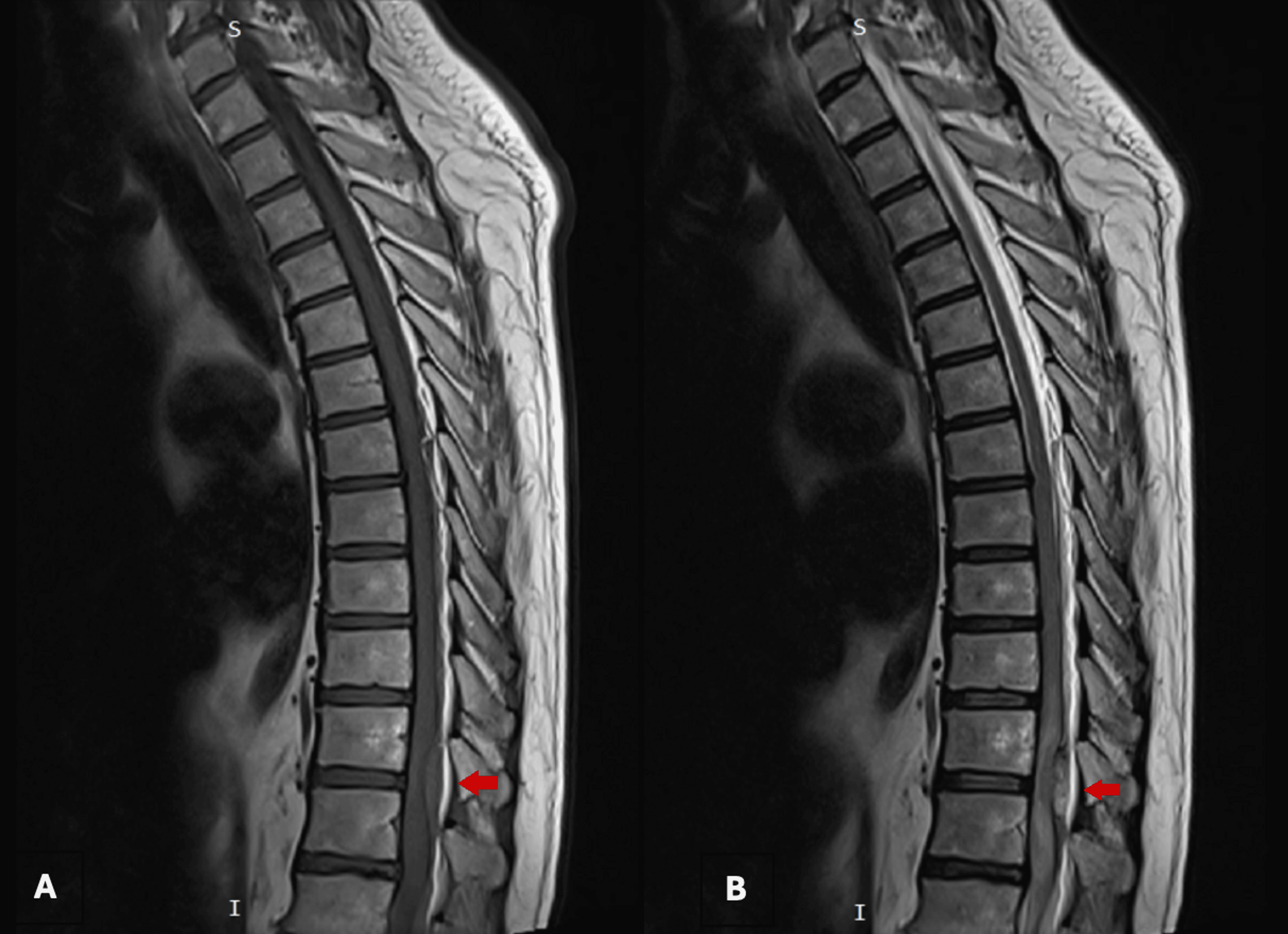 Cureus | Non-traumatic Spinal Subdural Hemorrhage Associated With ...