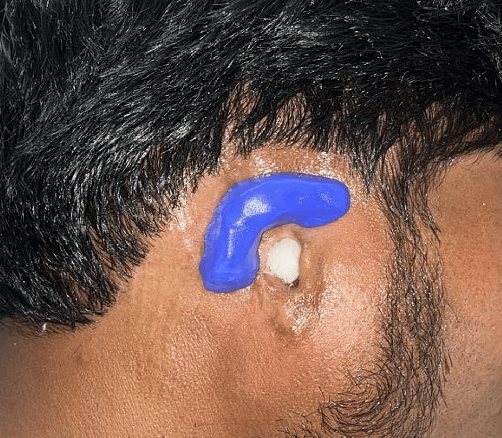 Fabrication of Implant-Supported Auricular Prosthesis Using Artificial ...