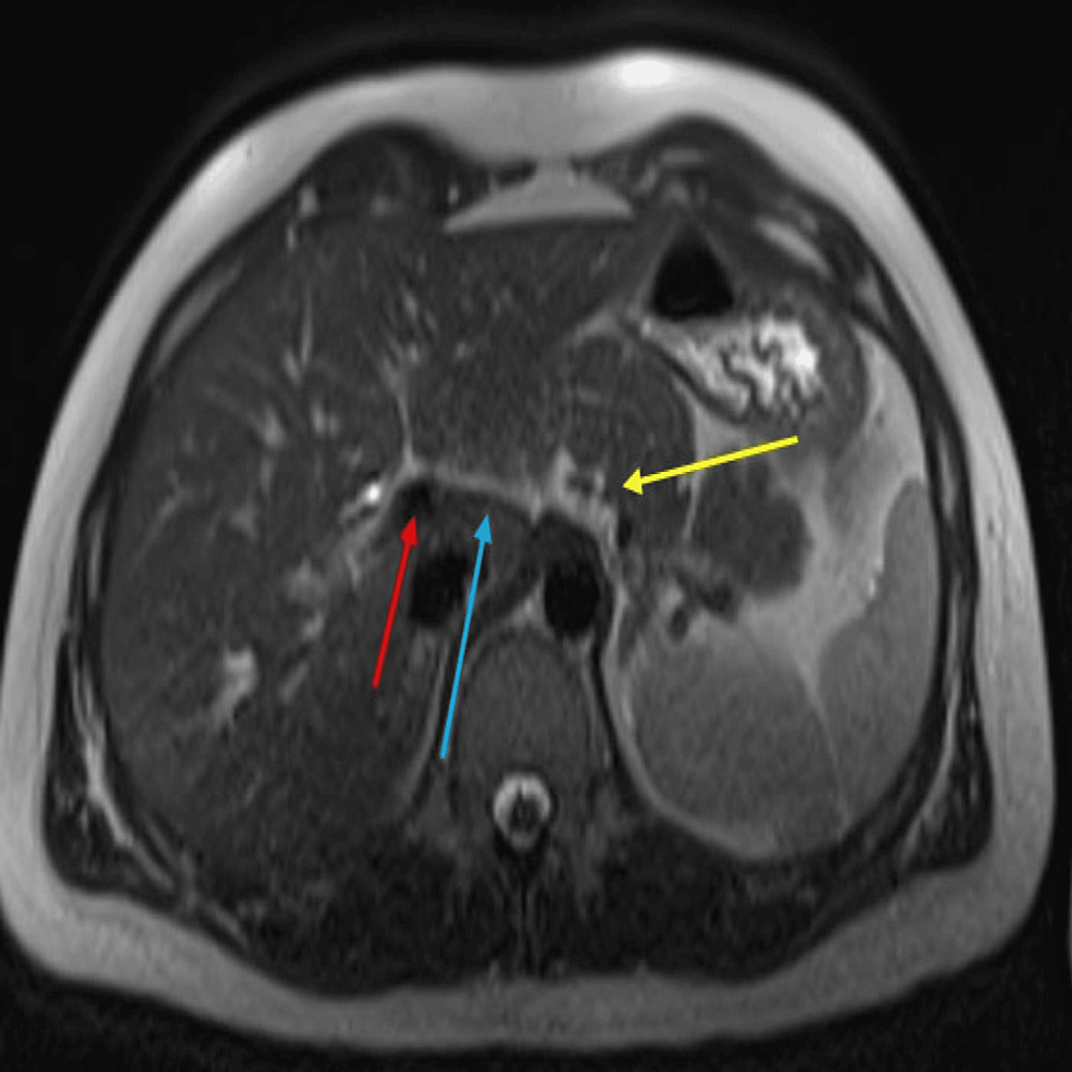 The Duodenal Accessory Ampulloma and the Role of Endoscopic Retrograde ...